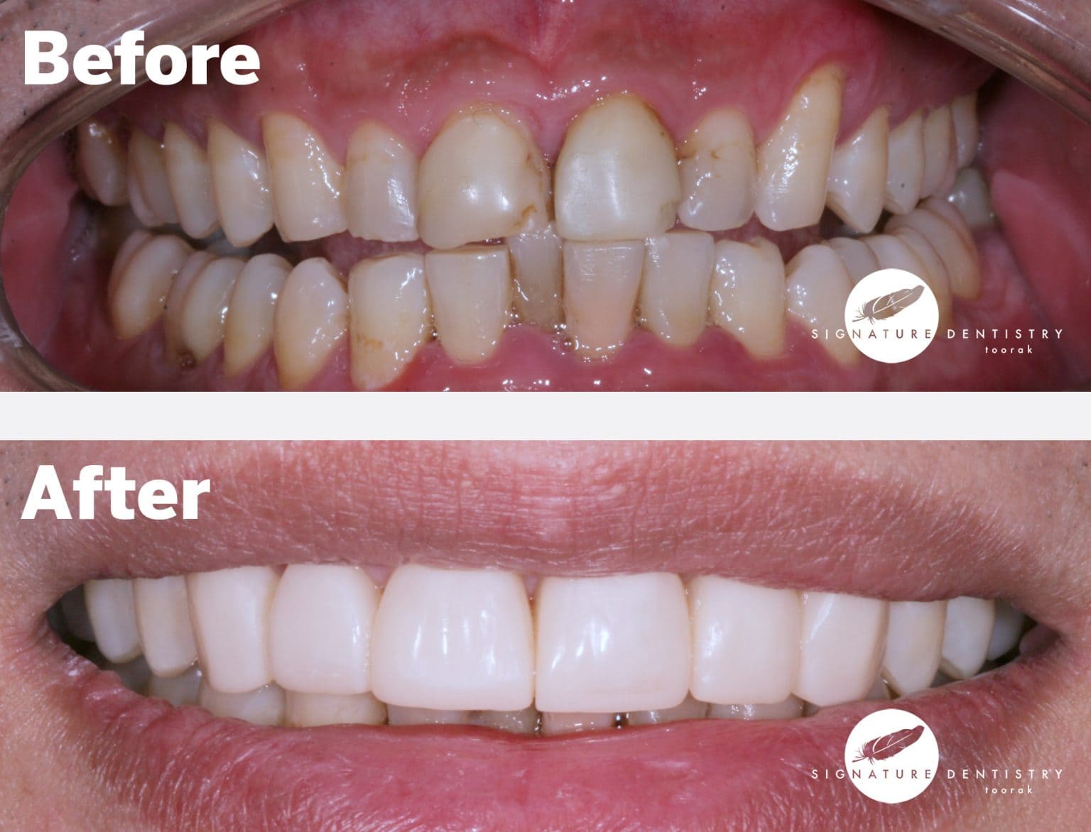 Veneers Before and After By Dr Kasen